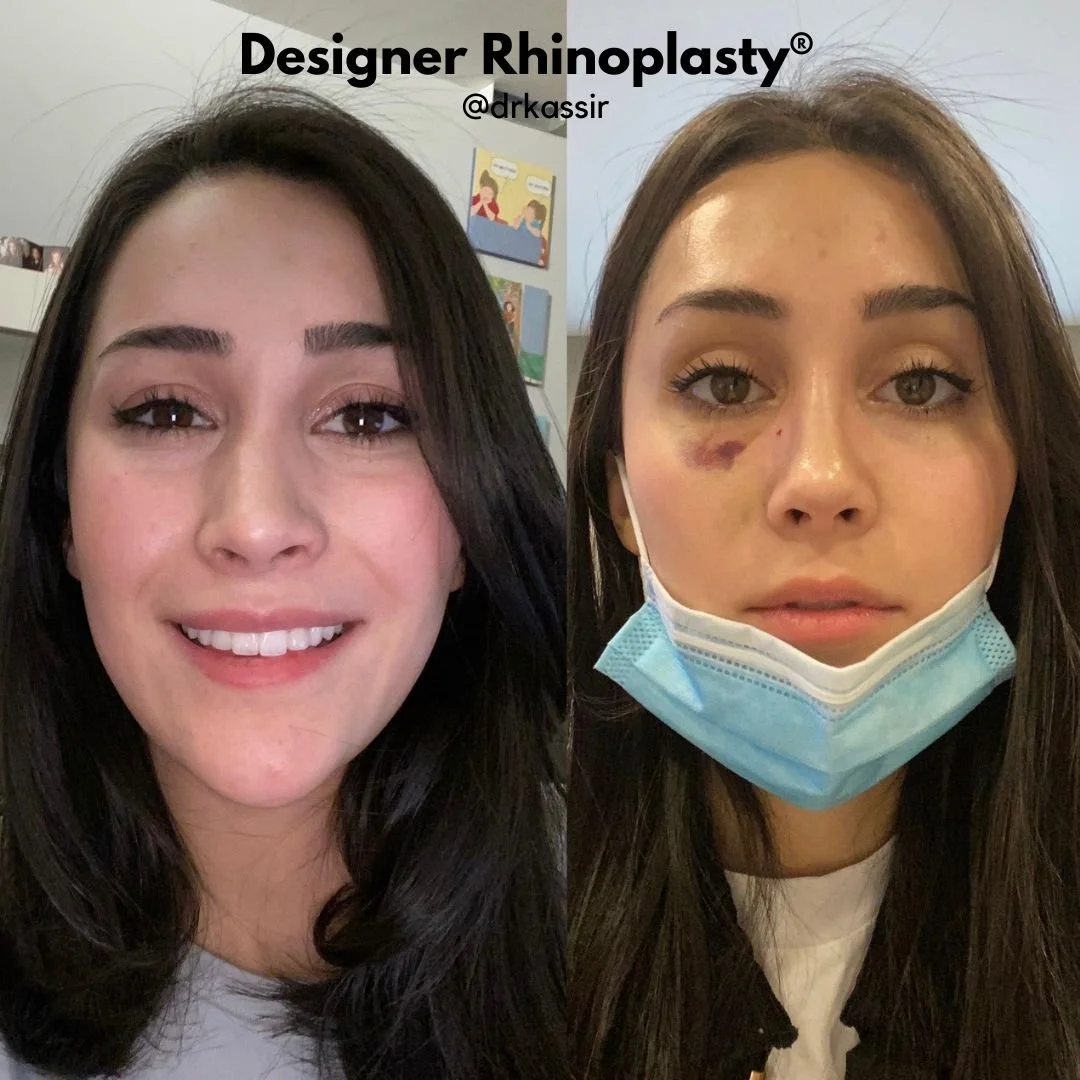 Best Rhinoplasty I Designer Rhinoplasty by Dr. Kassir — Kassir Plastic ...