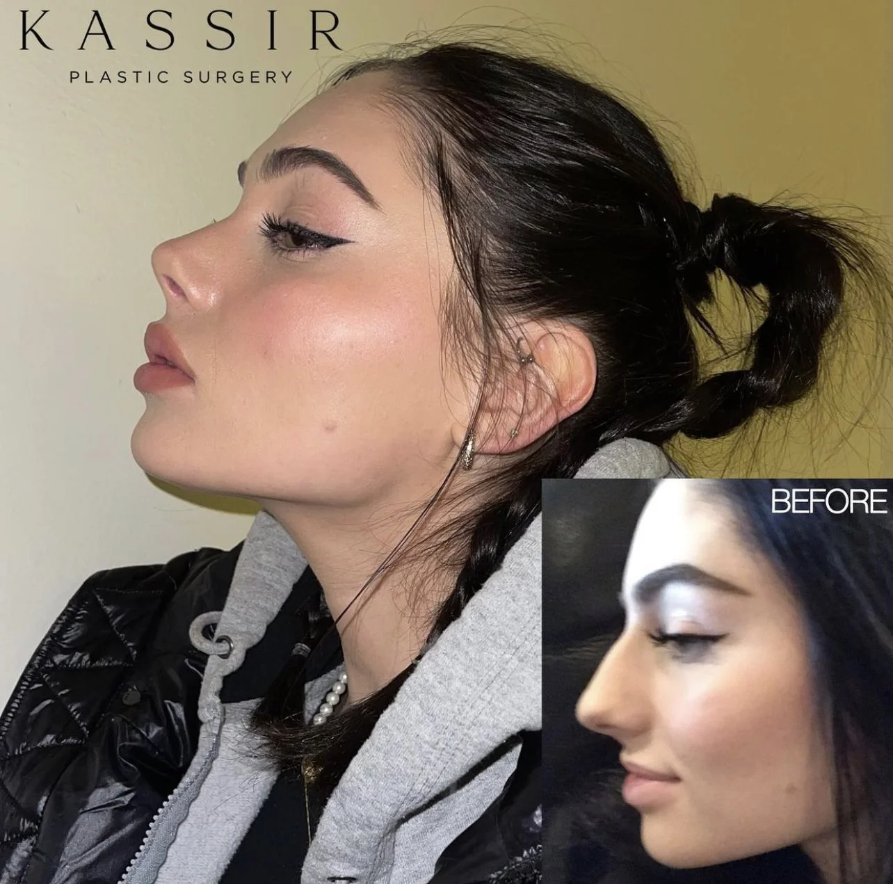 Best Rhinoplasty I Designer Rhinoplasty by Dr. Kassir — Kassir Plastic ...