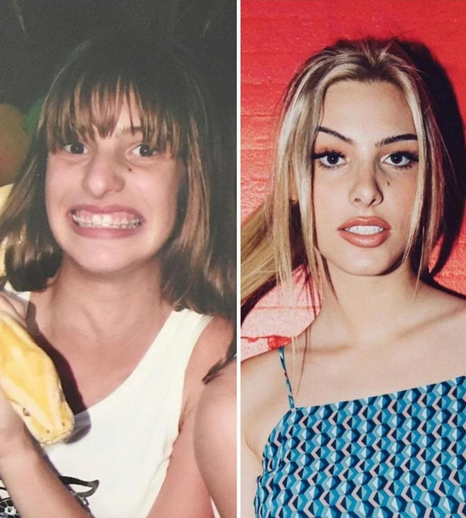 Lele Pons Rhinoplasty / Celebrity Rhinoplasty — Kassir Plastic Surgery ...