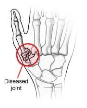 CARPOMETACARPAL ARTHRITIS — Miami Bone & Joint Institute | Premier ...