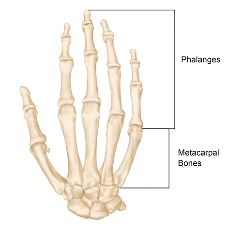 FRACTURE METACARPALS — Miami Bone & Joint Institute | Premier Center ...