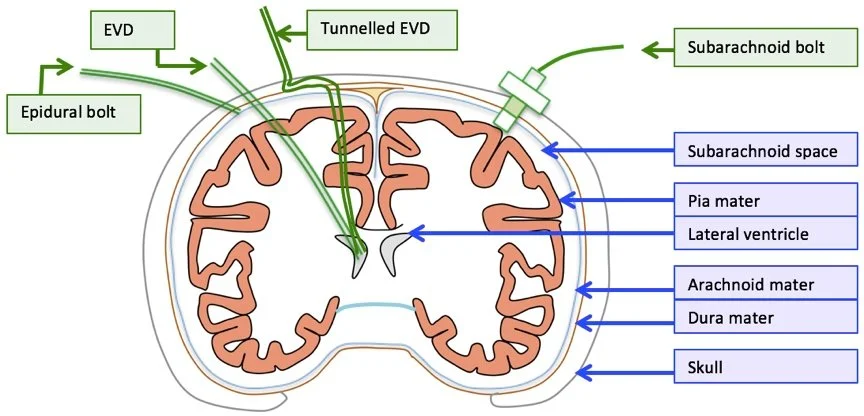 Intracranial Pressure (ICP) — In the ICU with Jessie Franco