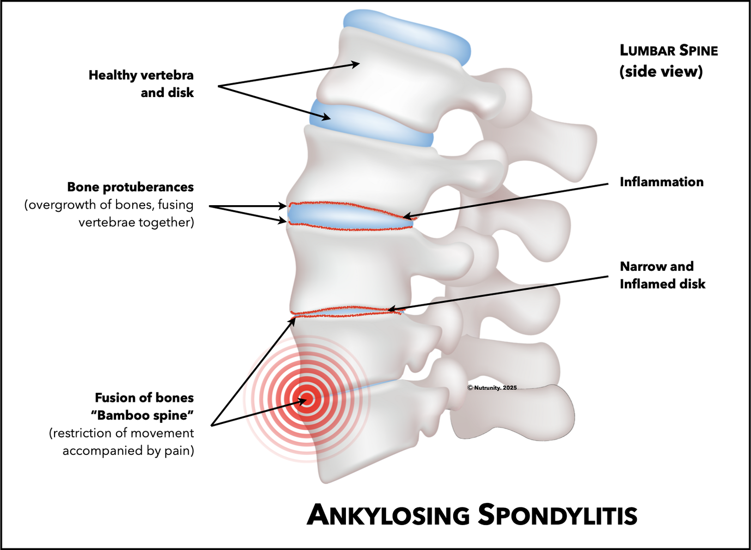 Comprehensive Guide to Ankylosing Spondylitis — Nutrunity⎪Naturopathic ...