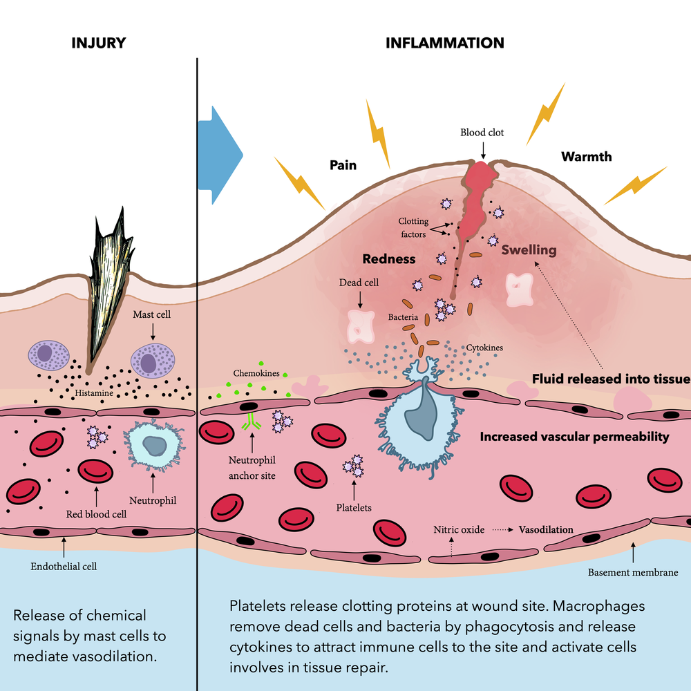 Inflammation under the spotlight. — Nutrunity⎪Naturopathic Clinic ...