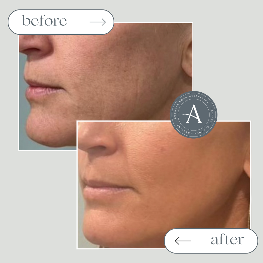 Introducing MicroGlow+: The Ultimate Skin Rejuvenation — Augusta Road ...