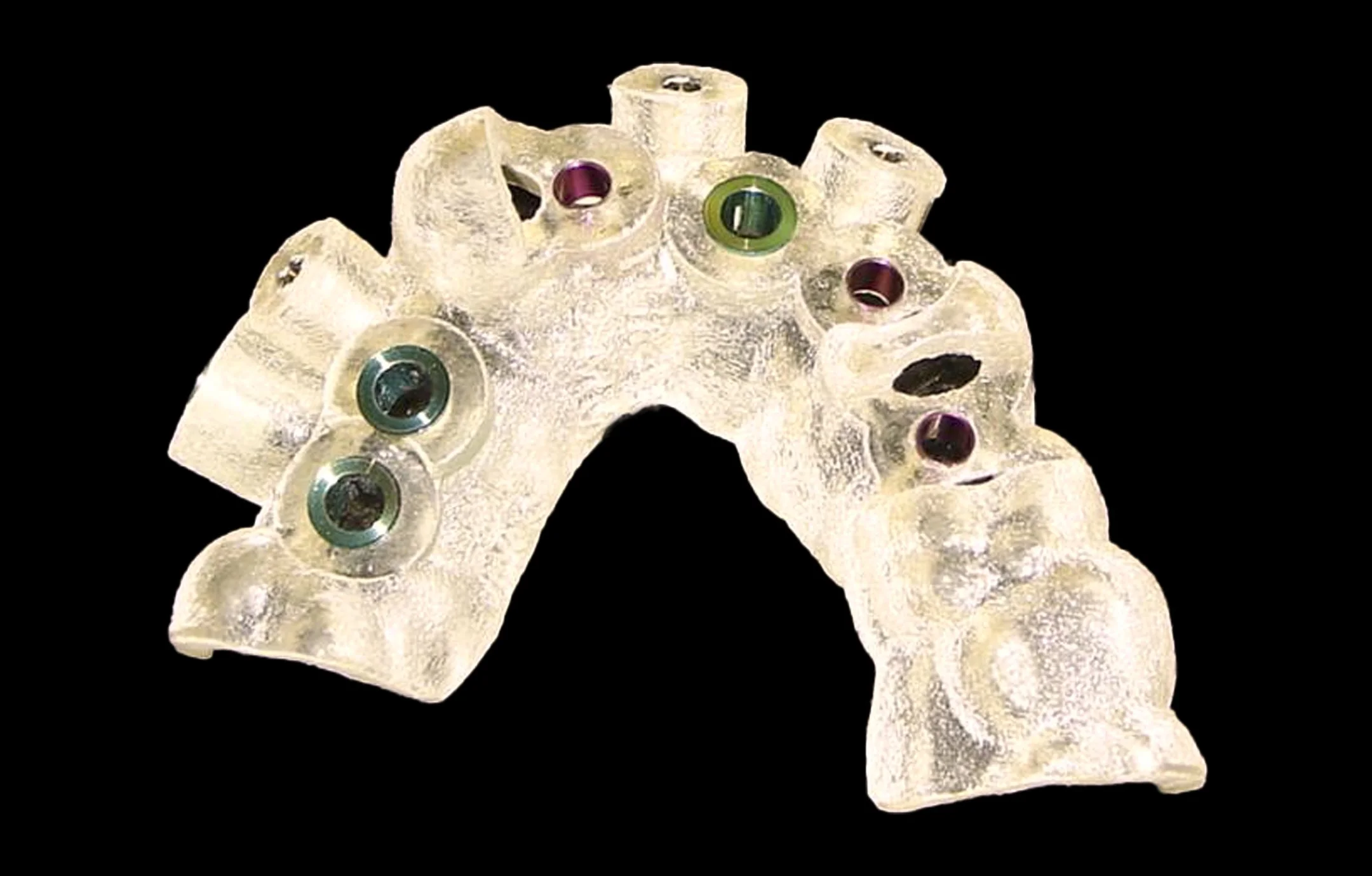 SGT Guides | Stackable Surgical Guides | Dental Guided Surgery ...