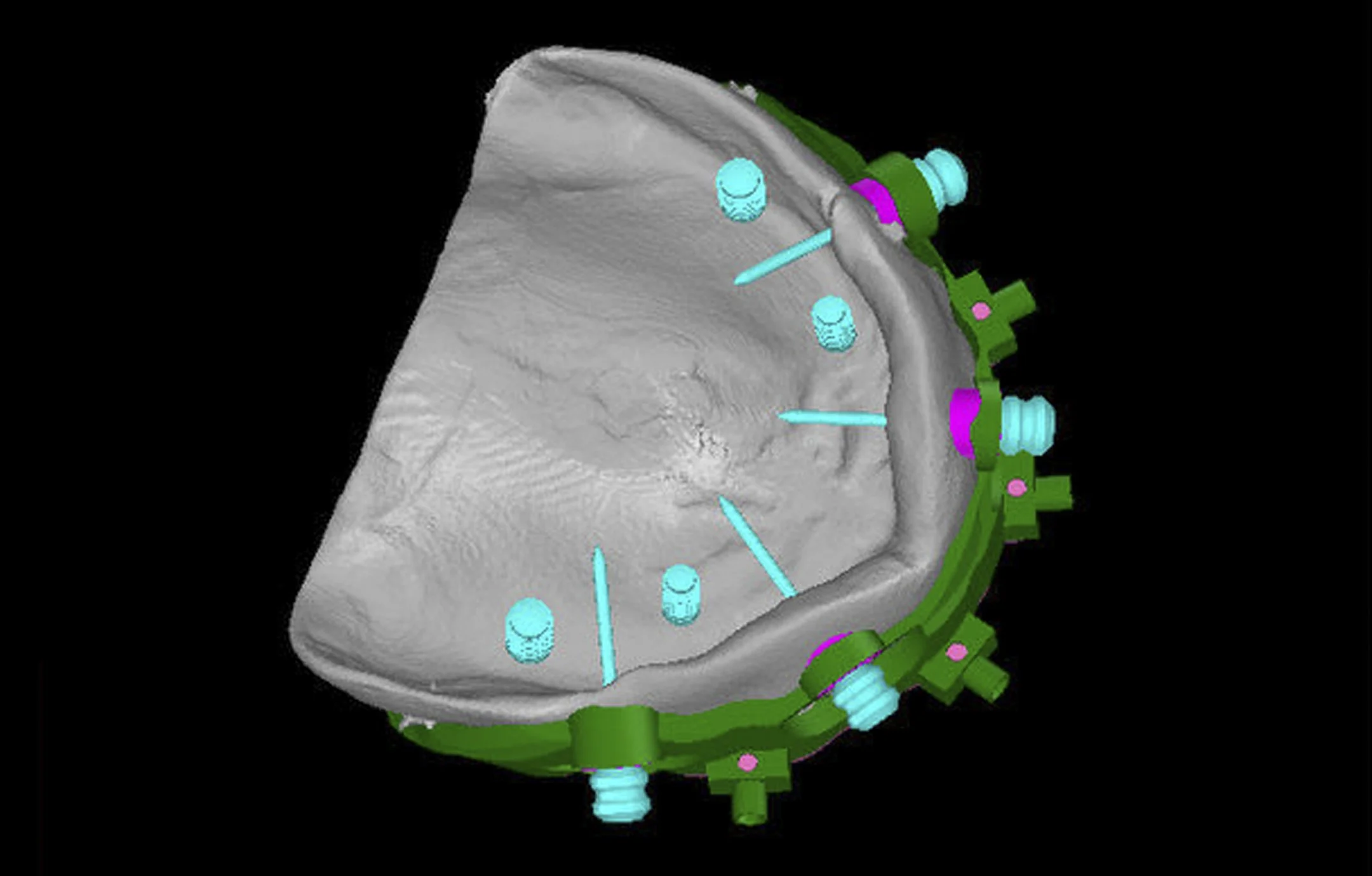SGT Guides | Stackable Surgical Guides | Dental Implant Guided Surgery ...