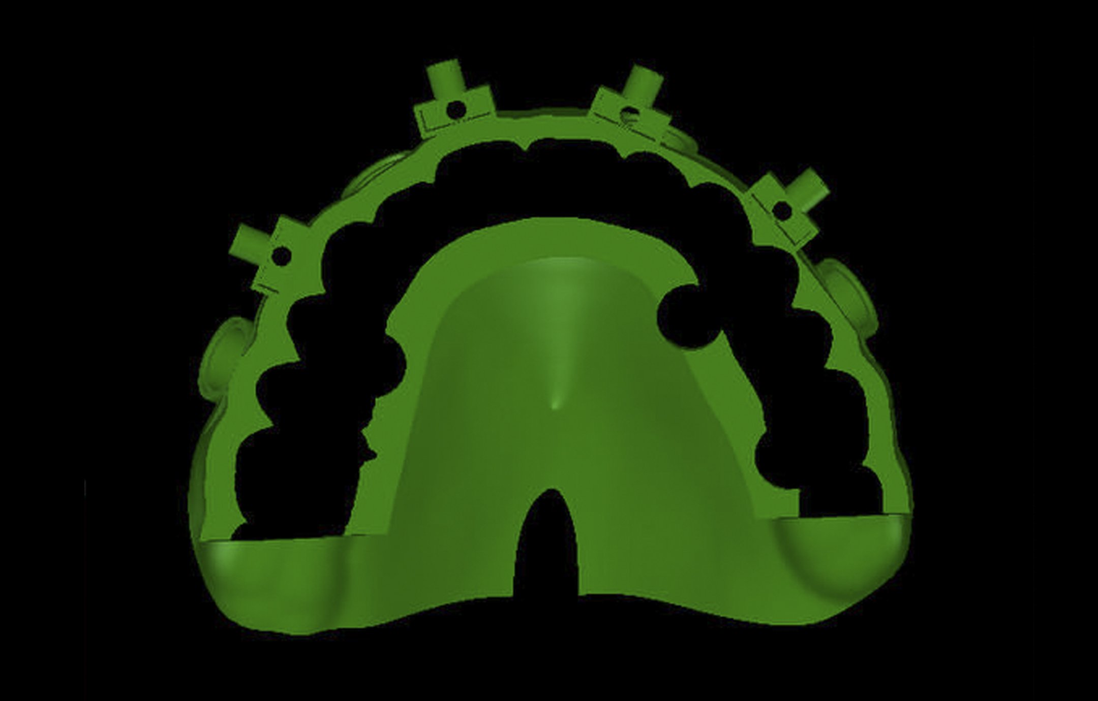 SGT Guides | Stackable Surgical Guides | Dental Implant Guided Surgery ...