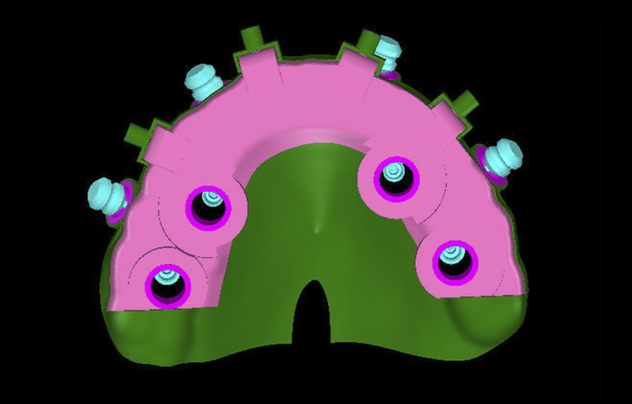 SGT Guides | Stackable Surgical Guides | Dental Implant Guided Surgery ...