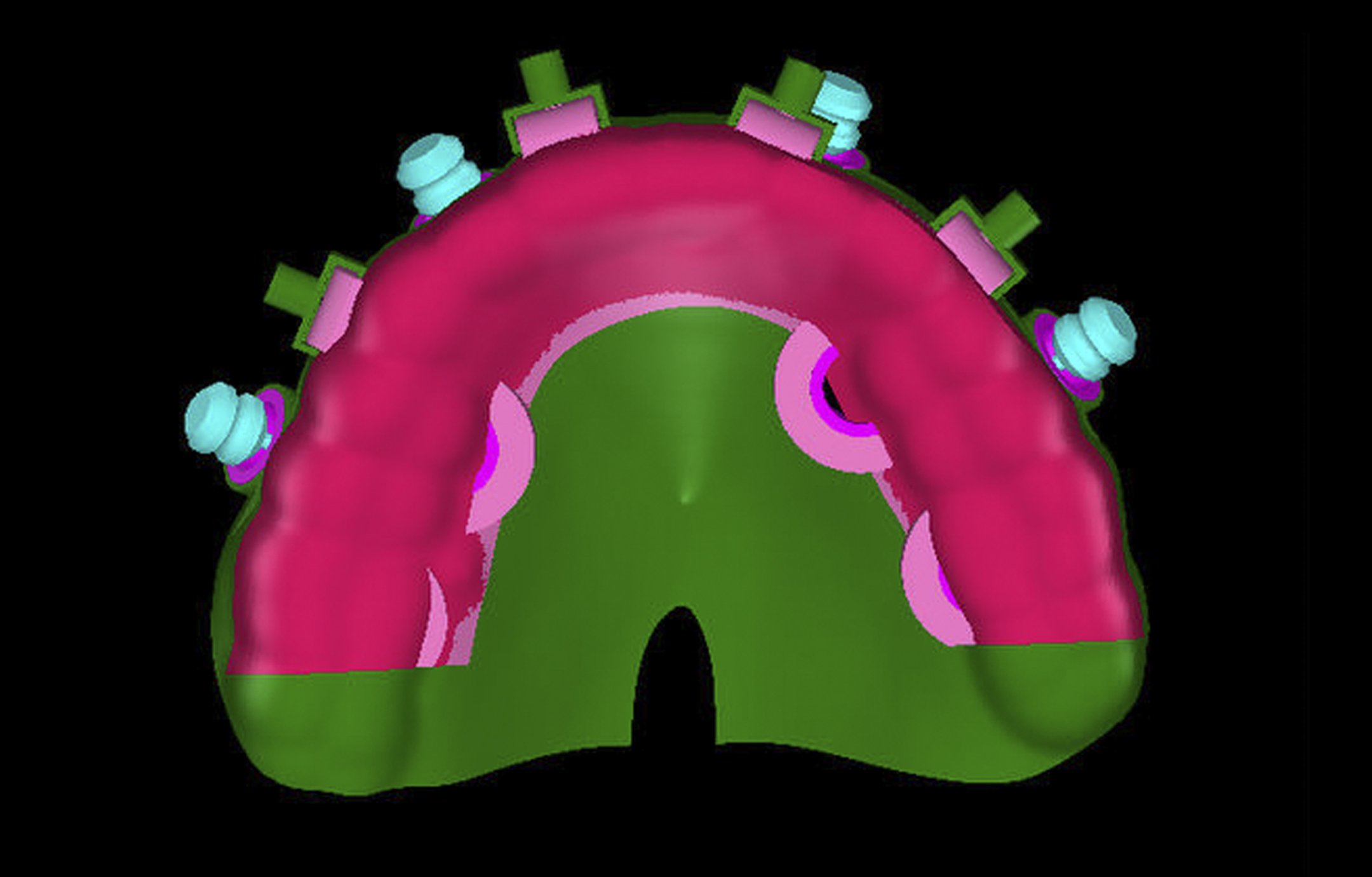 SGT Guides | Stackable Surgical Guides | Dental Implant Guided Surgery ...