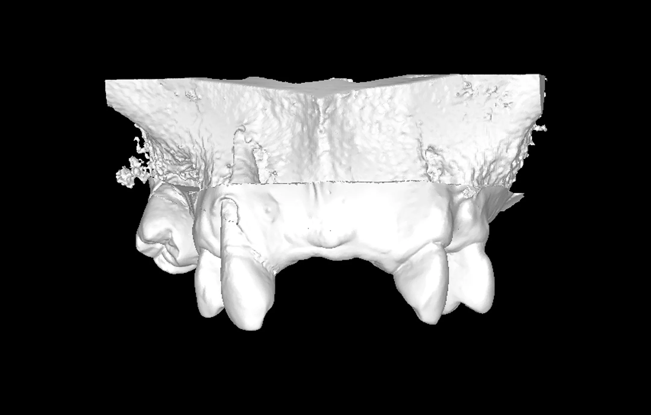 SGT Guides | Stackable Surgical Guides | Dental Implant Guided Surgery ...