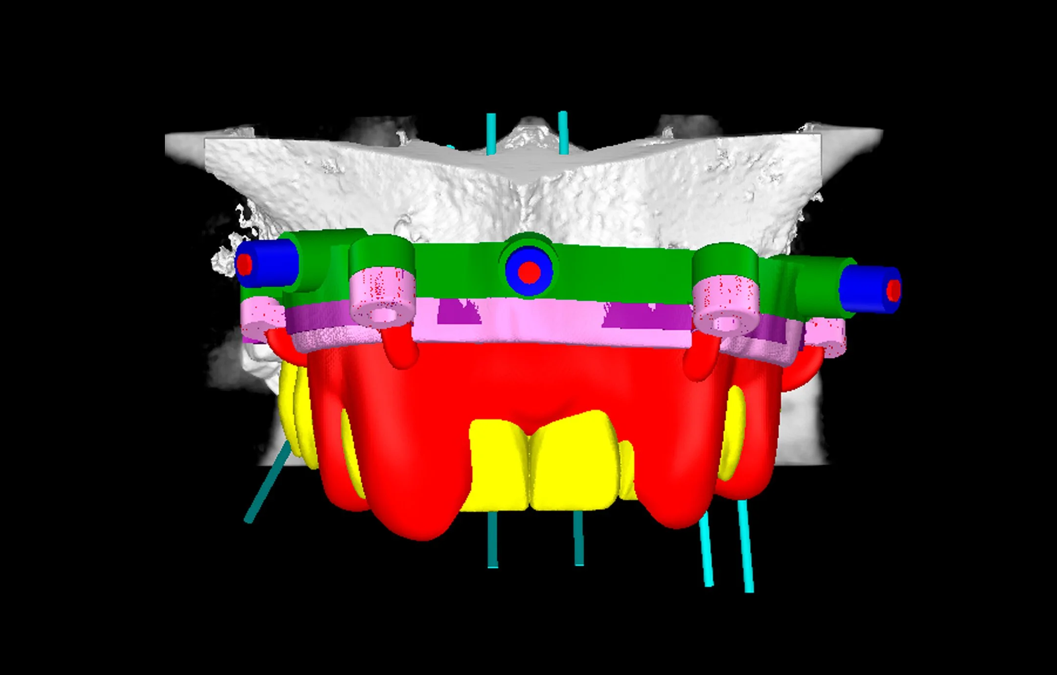 SGT Guides | Stackable Surgical Guides | Dental Implant Guided Surgery ...