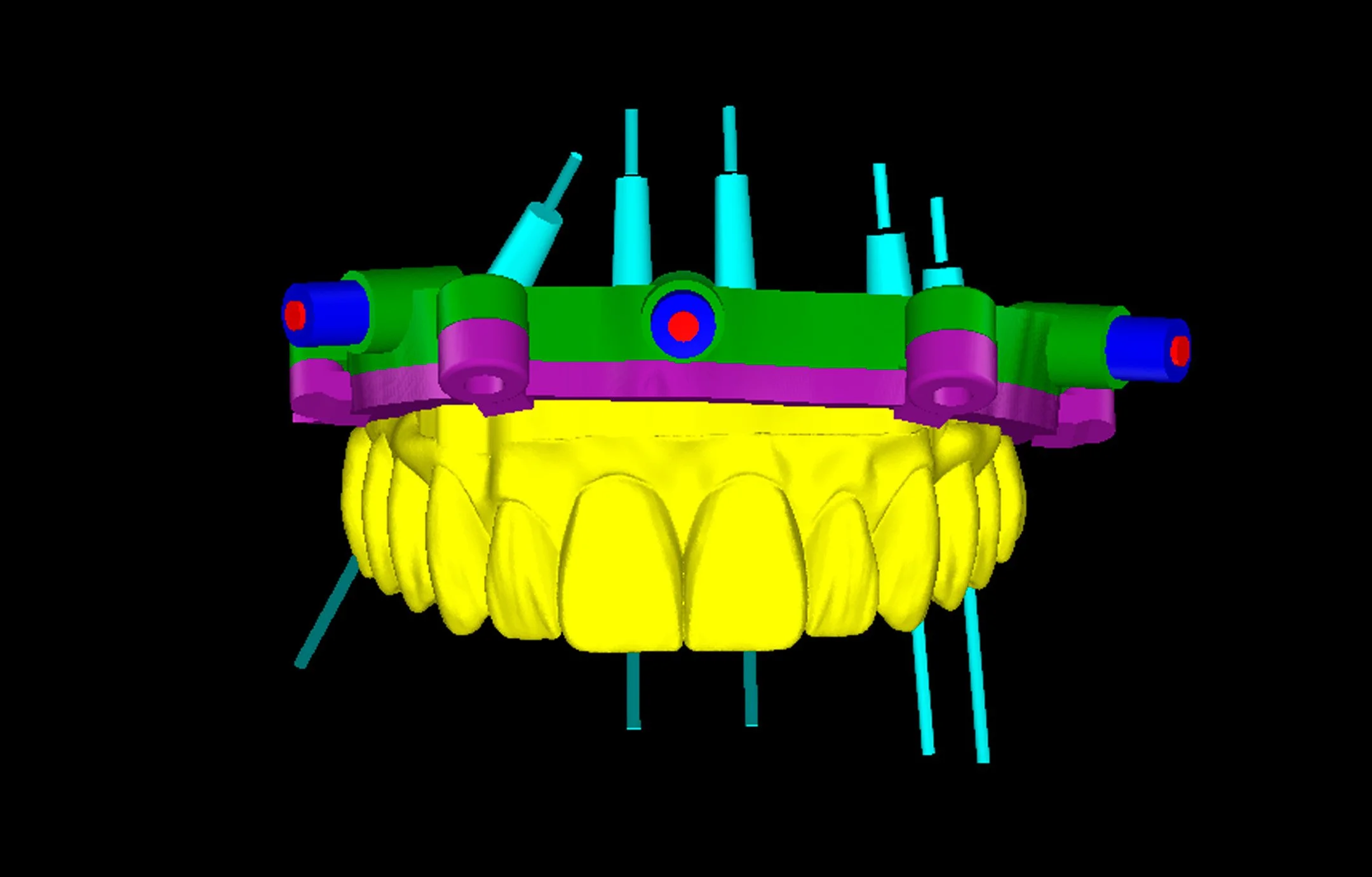 SGT Guides | Stackable Surgical Guides | Dental Implant Guided Surgery ...