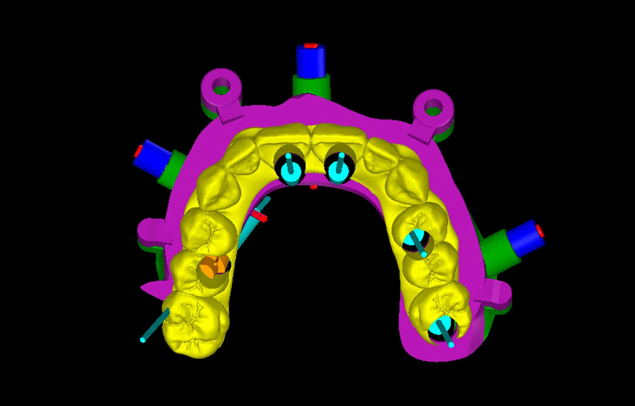 SGT Guides | Stackable Surgical Guides | Dental Implant Guided Surgery ...