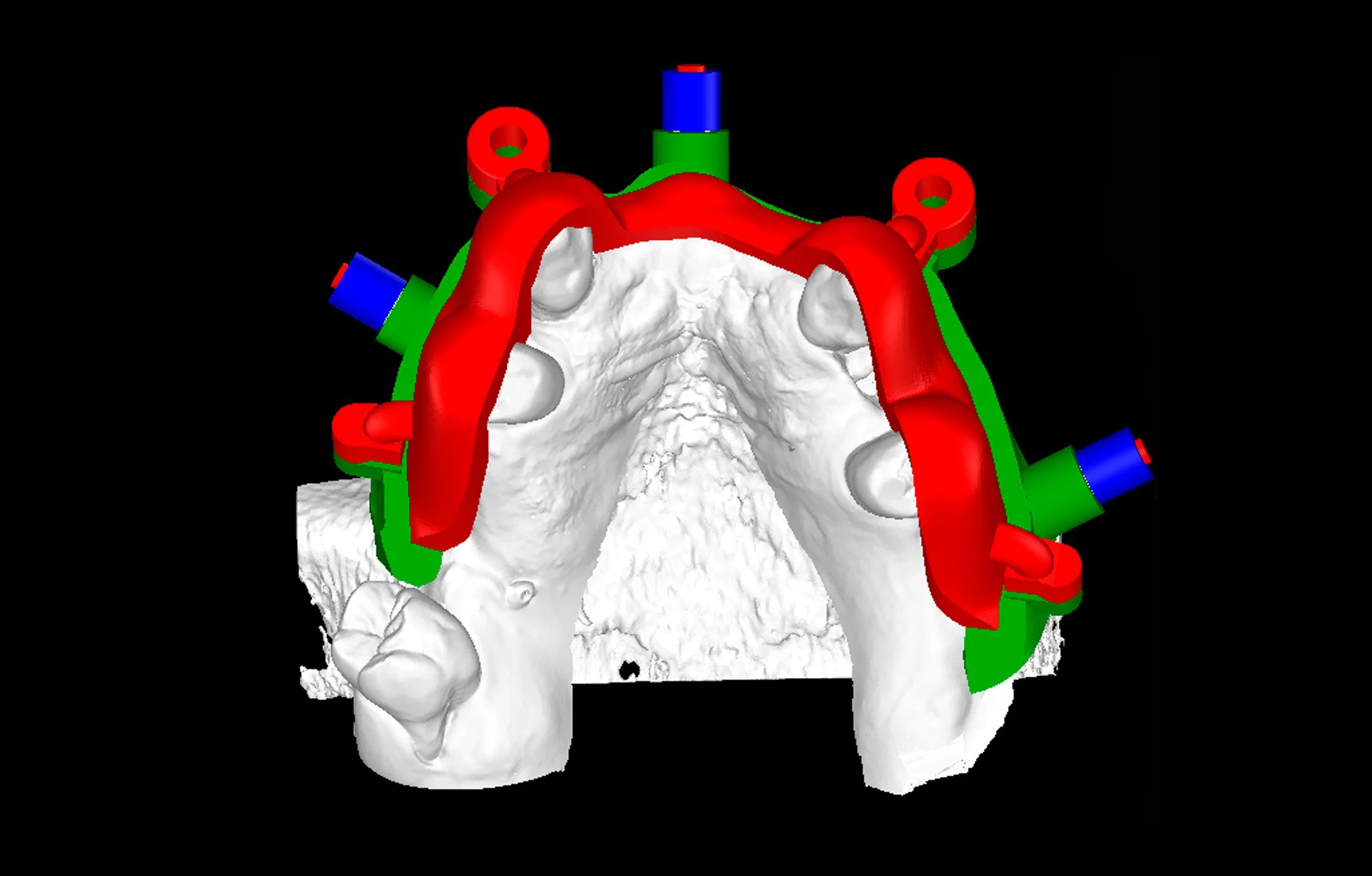 SGT Guides | Stackable Surgical Guides | Dental Implant Guided Surgery ...