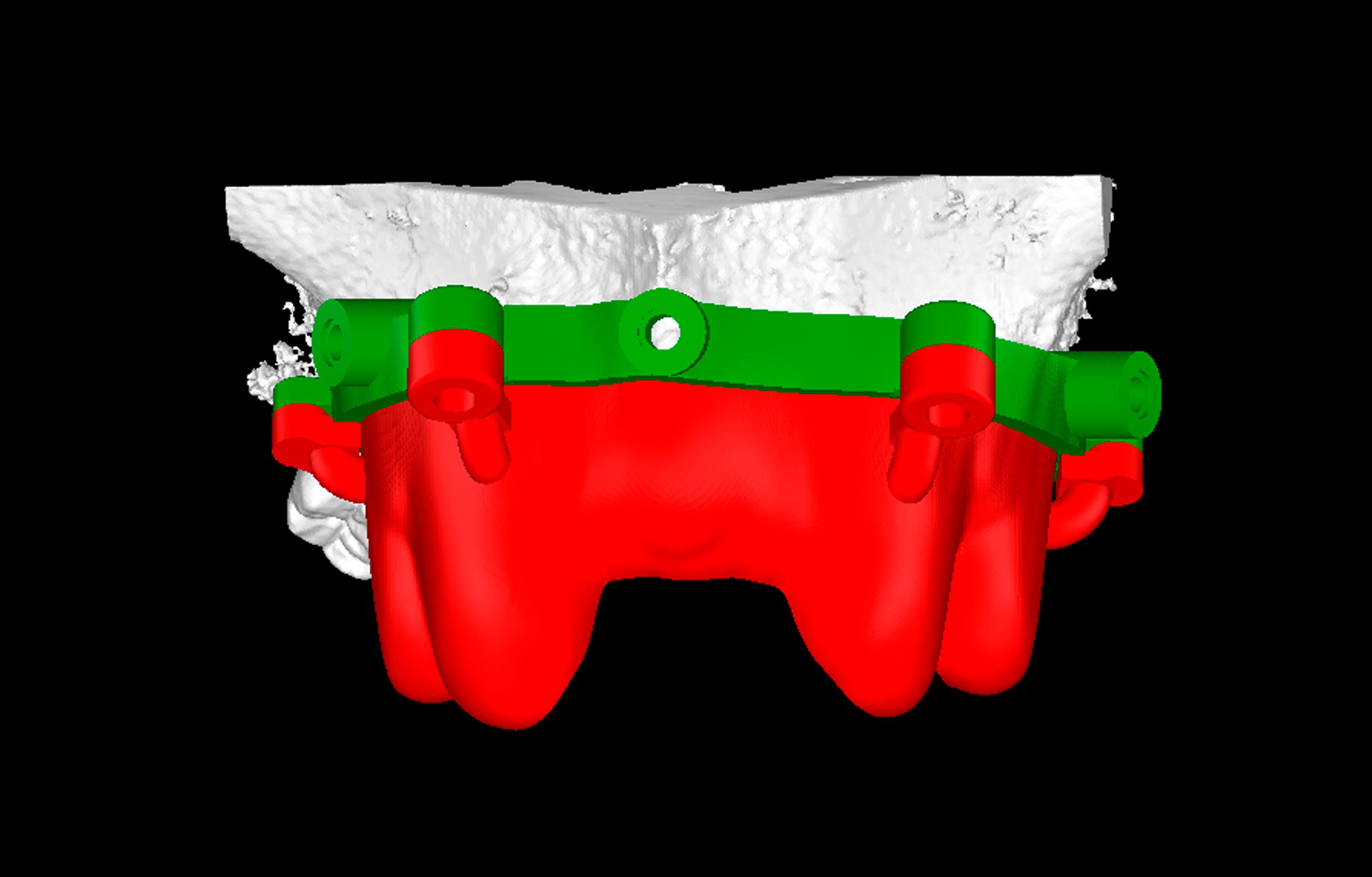 SGT Guides | Stackable Surgical Guides | Dental Implant Guided Surgery ...