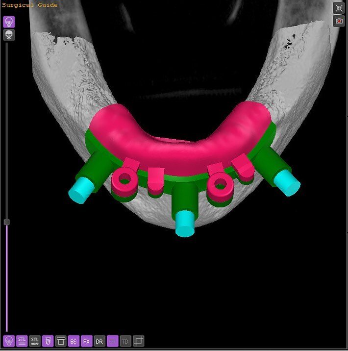 SGT Guides | Stackable Surgical Guides | Dental Implant Guided Surgery ...