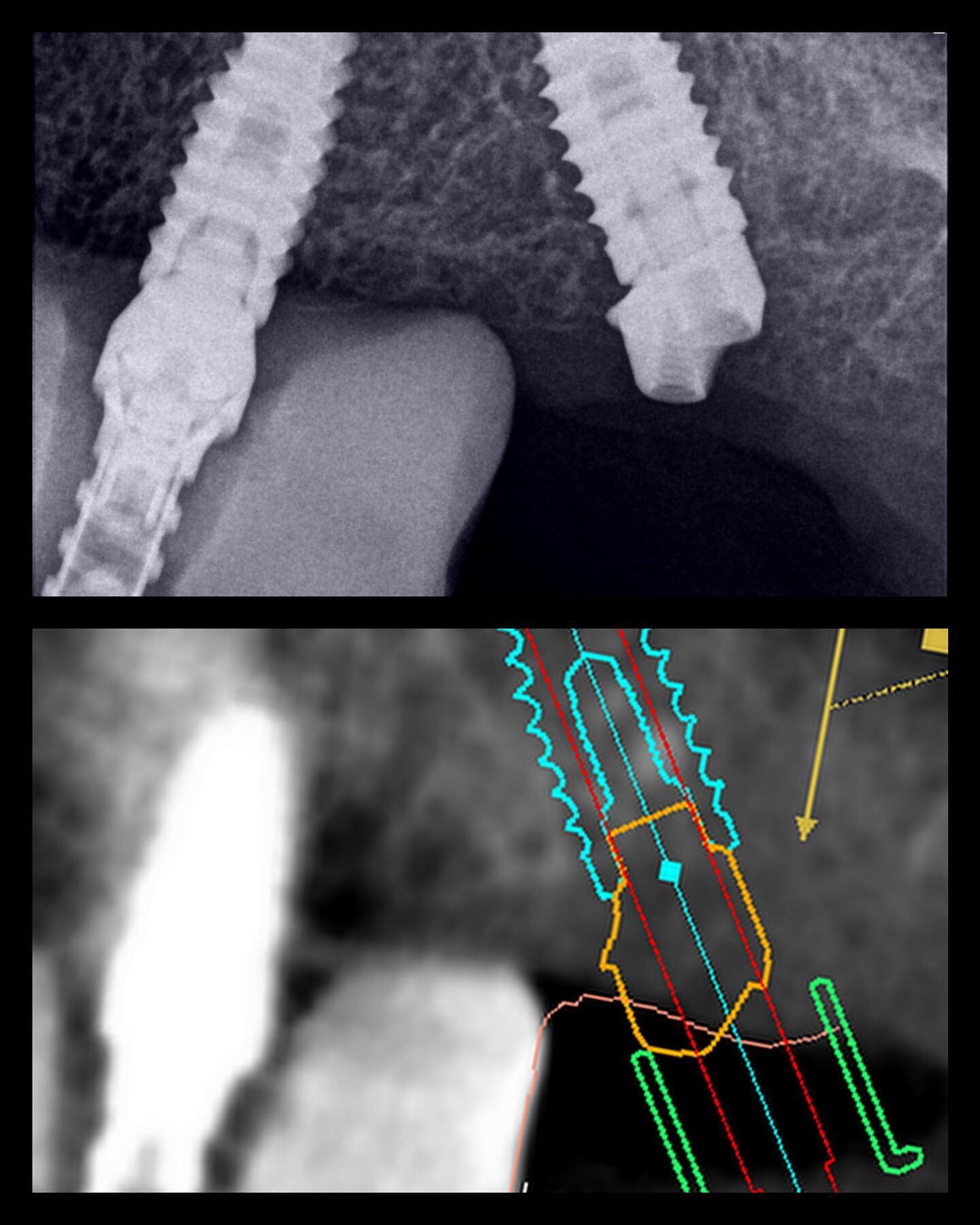 SGT Guides | Stackable Surgical Guides | Dental Guided Surgery ...