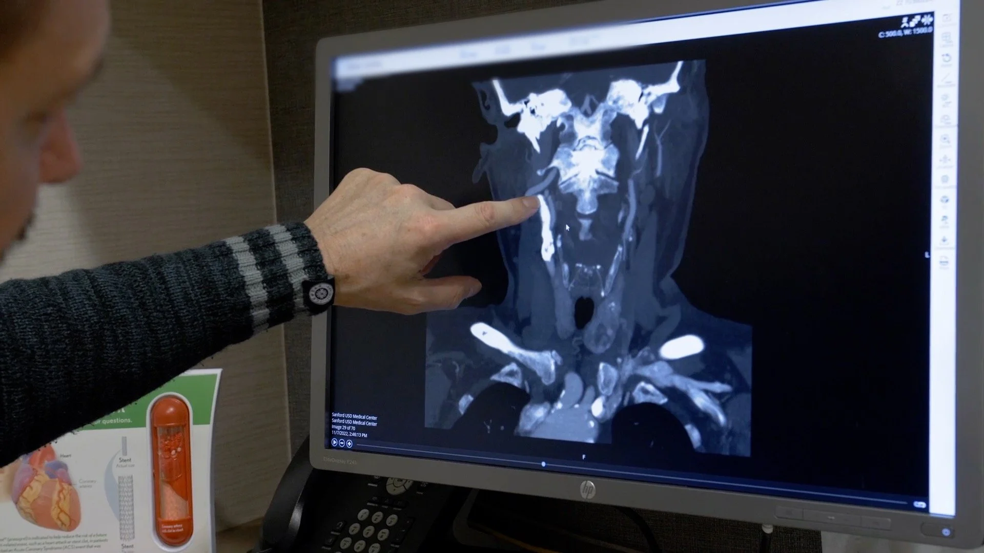Total vascular care for your patient at Sanford Vascular Associates ...