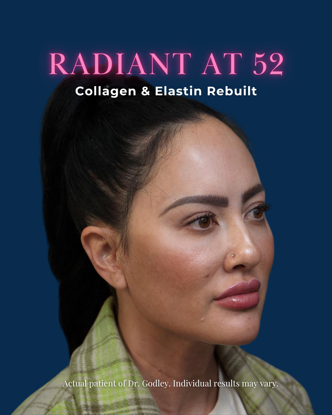 Sculptra vs Rich PL: How Regenerative Injectables Work — Godley Clinic
