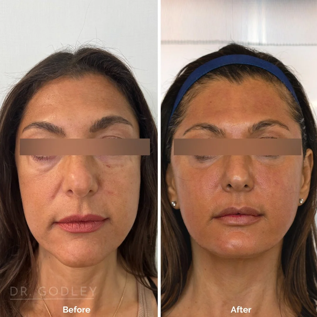 Non-Surgical Face Lift — Godley Clinic