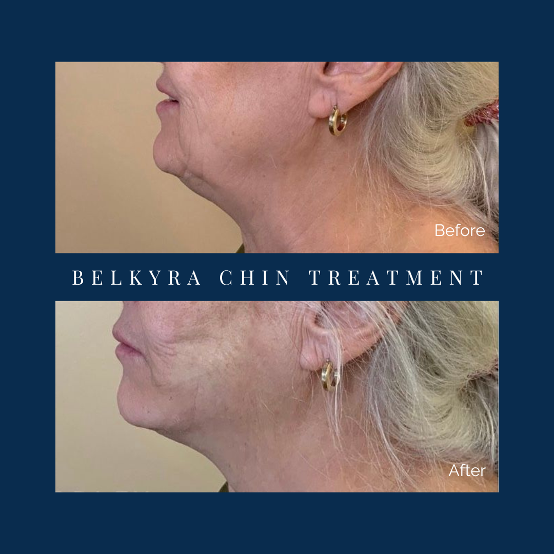 Belkyra Vancouver B.C. — Godley Clinic