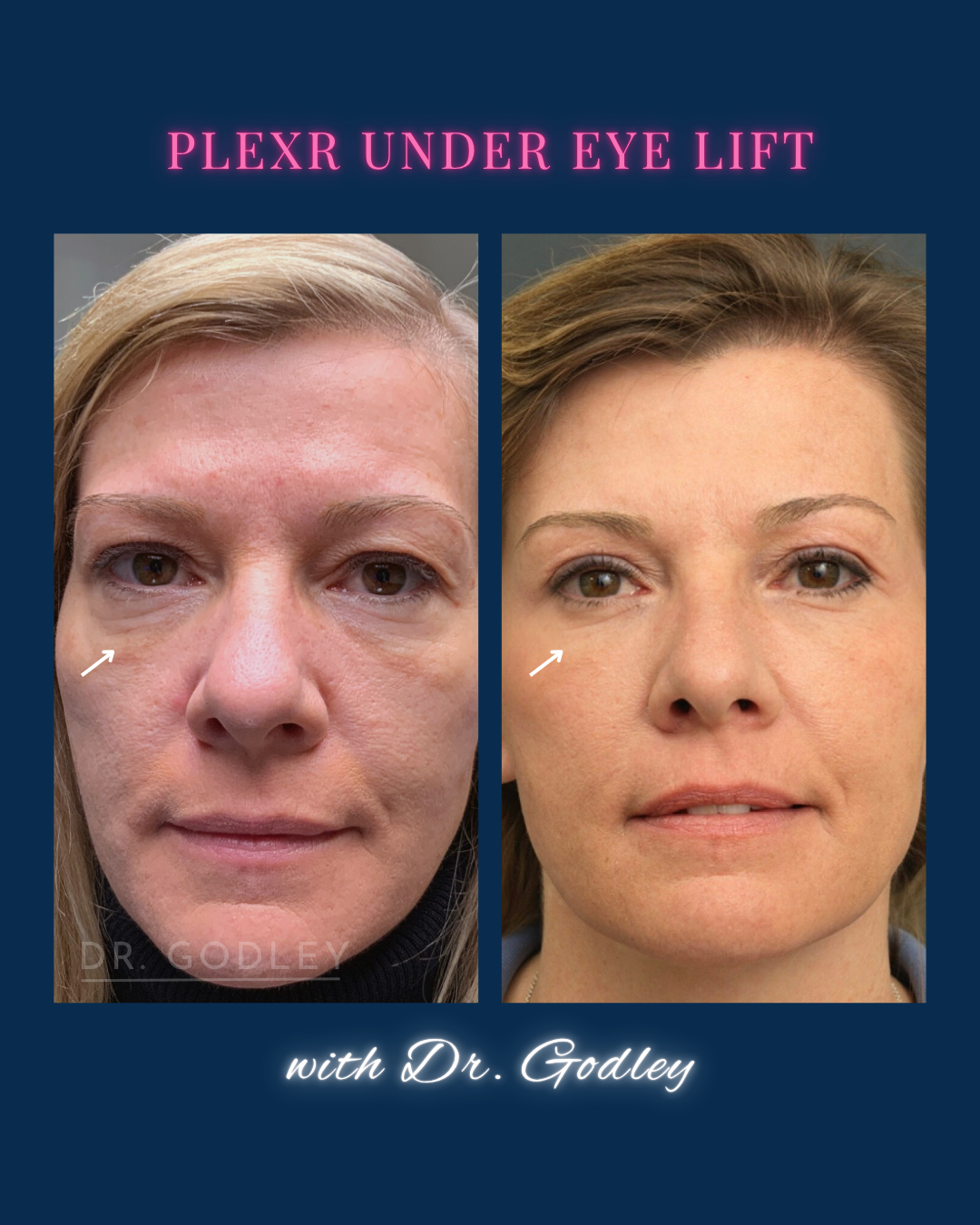 Plexr Plus Vancouver B.C. — Godley Clinic