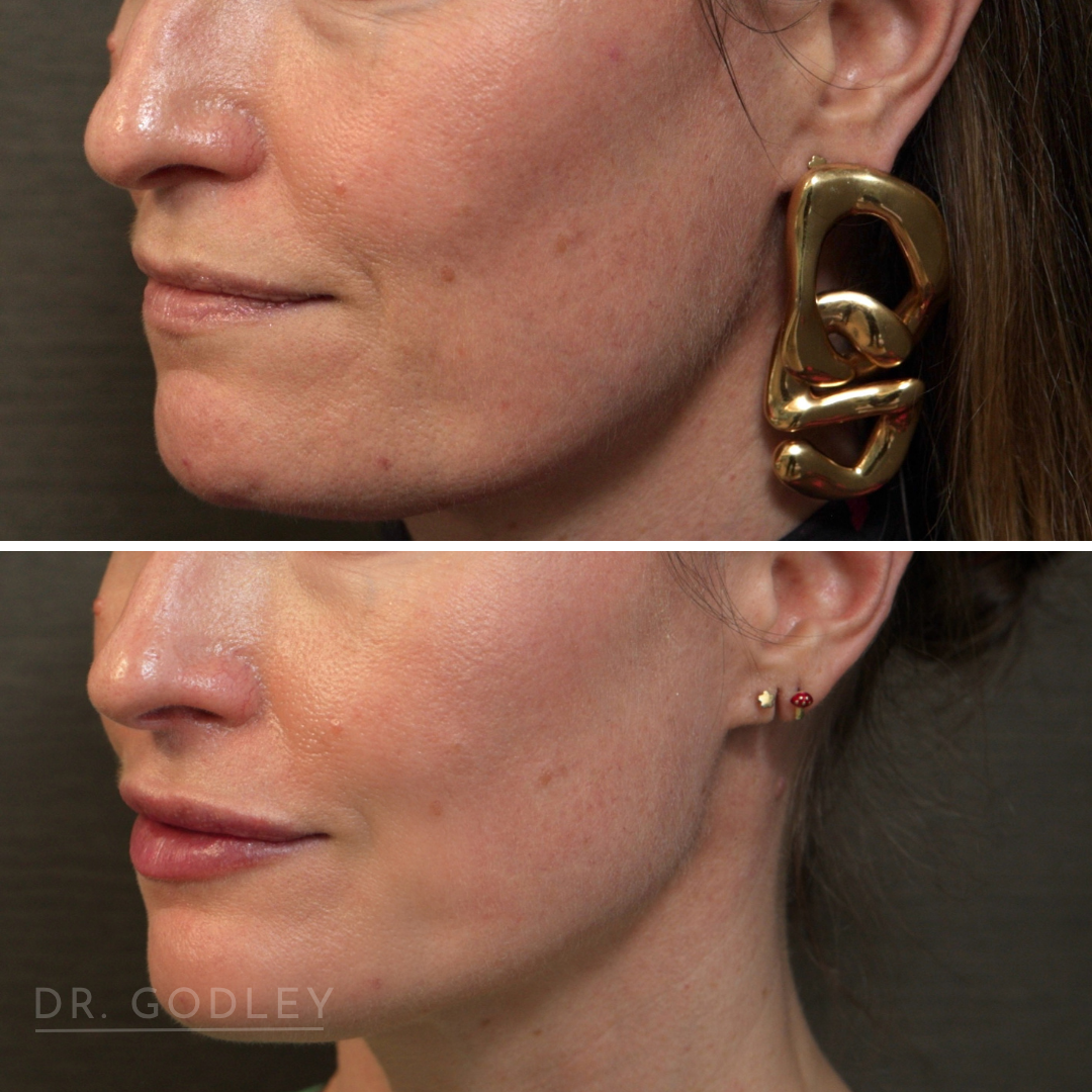 Lip Filler Injections Vancouver B.C. — Godley Clinic