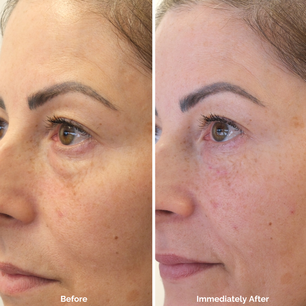 Anti Aging Eye Treatments — Godley Clinic
