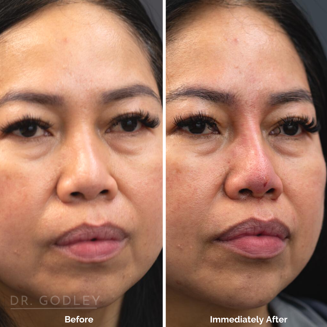Non-Surgical Nose Job — Godley Clinic