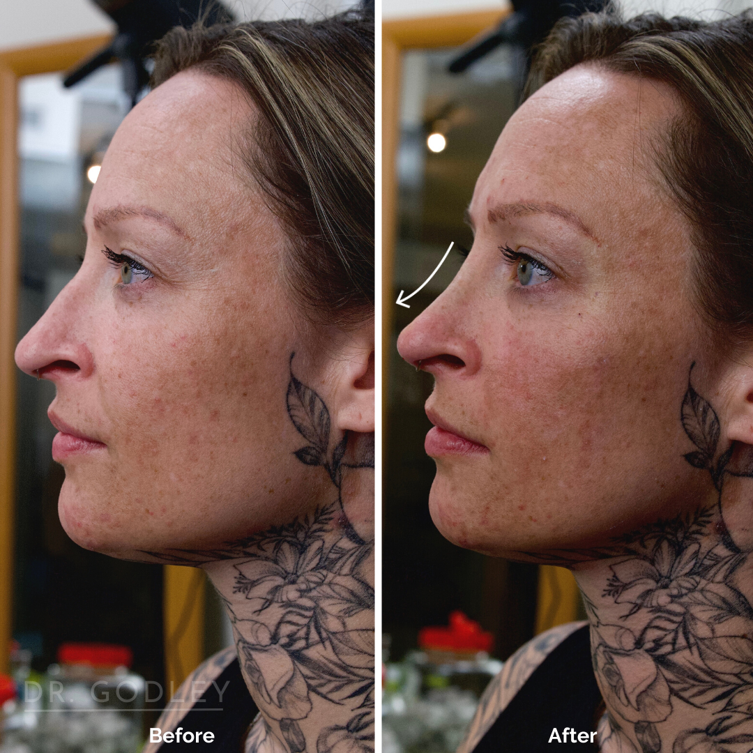 Non-Surgical Nose Job — Godley Clinic