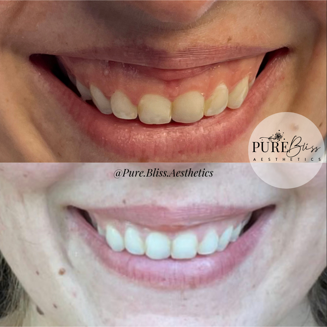 Botox for Gummy Smile: Unlock your Perfect Smile — Pure Bliss Aesthetics
