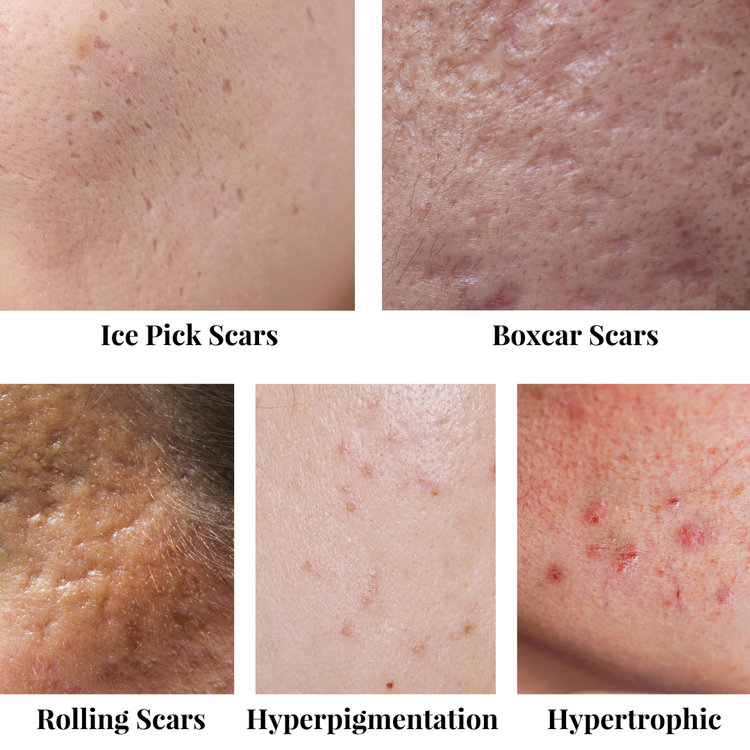 Understanding Acne Scarring: Causes, Types, & Effective Treatments ...