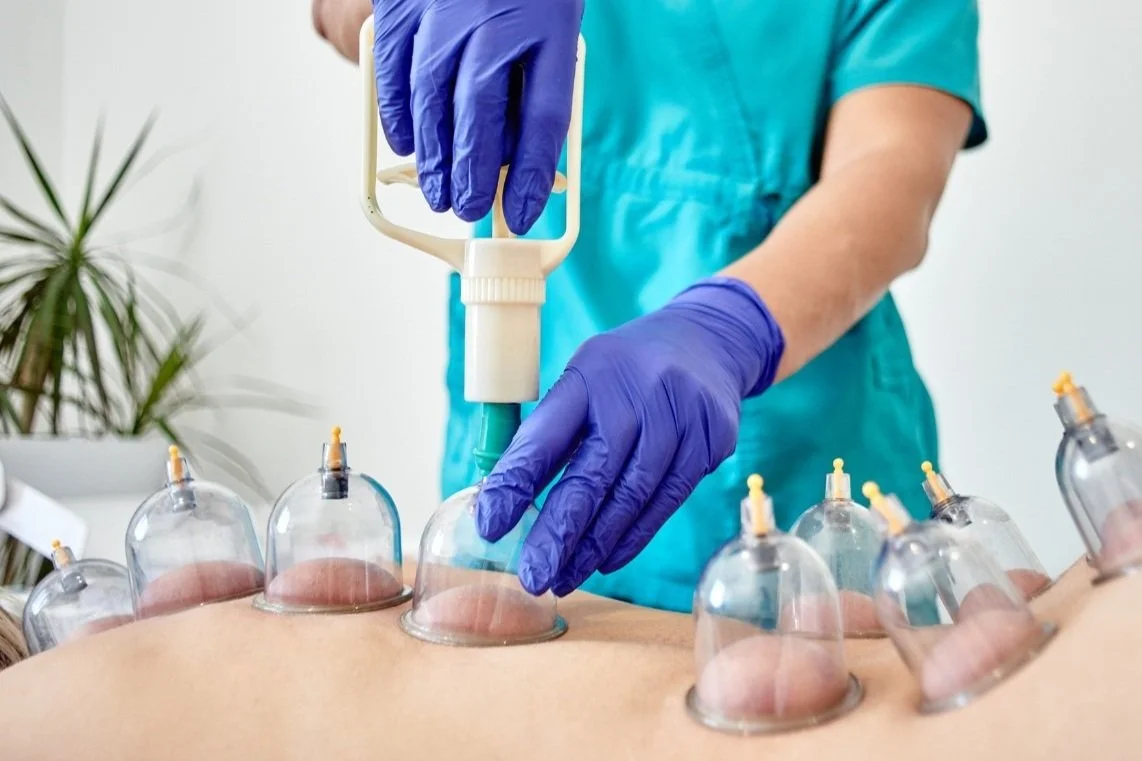 What is Hijama? | Sunnah-Based Cupping Therapy for Women in North ...