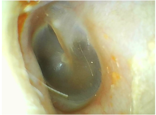 Grommet surgery for children: what parents need to know — Hearing ...