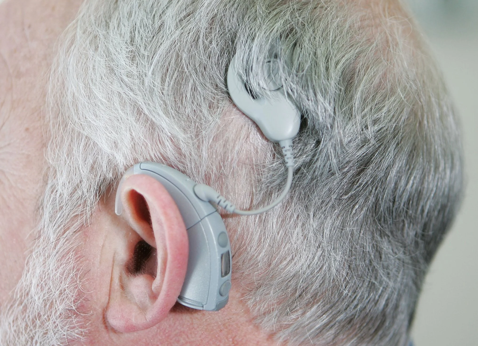 Cochlear implants — Hearing Institute | Tinnitus specialists