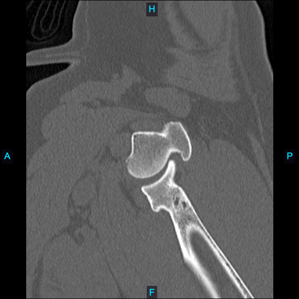 KODA : medial coronoid disease > — Spryng with OsteoCushion Technology