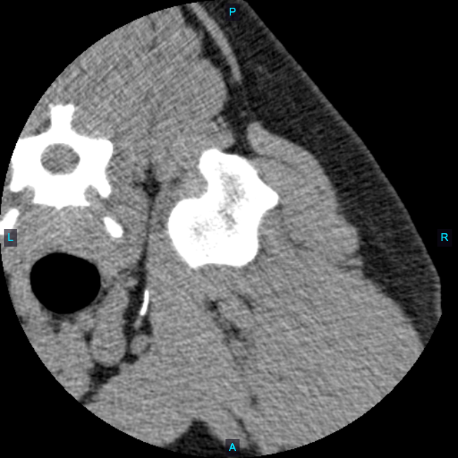 KODA : medial coronoid disease > — Spryng with OsteoCushion Technology