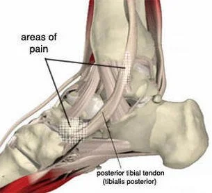 Posterior Tibial Tendinitis — Anaheim Hills Podiatry Group