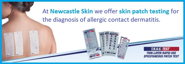 Skin Patch Testing: Newcastle's Trusted Allergy Evaluation