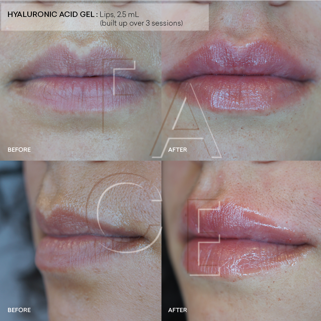 Is It Safe To Use Hyaluronic Acid On Lips | Lipstutorial.org