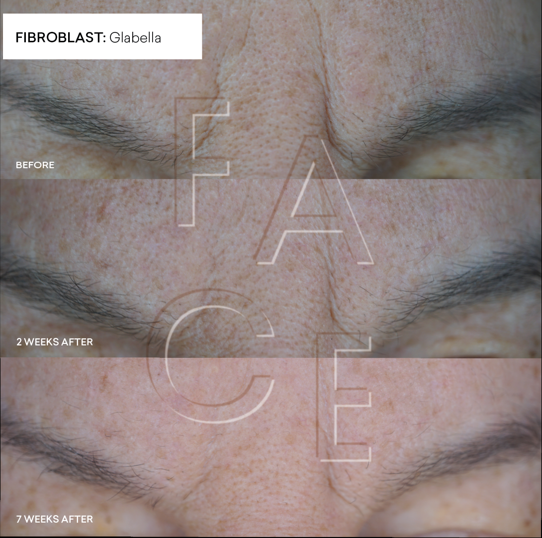 Plasma Fibroblast Skin Tightening with Plasma Pen | Oakland & LA — FACE
