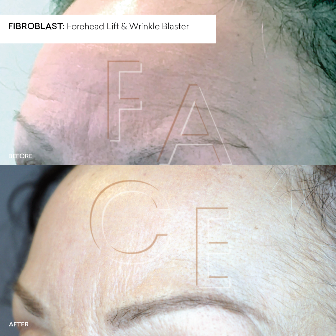 Plasma Fibroblast Skin Tightening with Plasma Pen | Oakland & LA — FACE