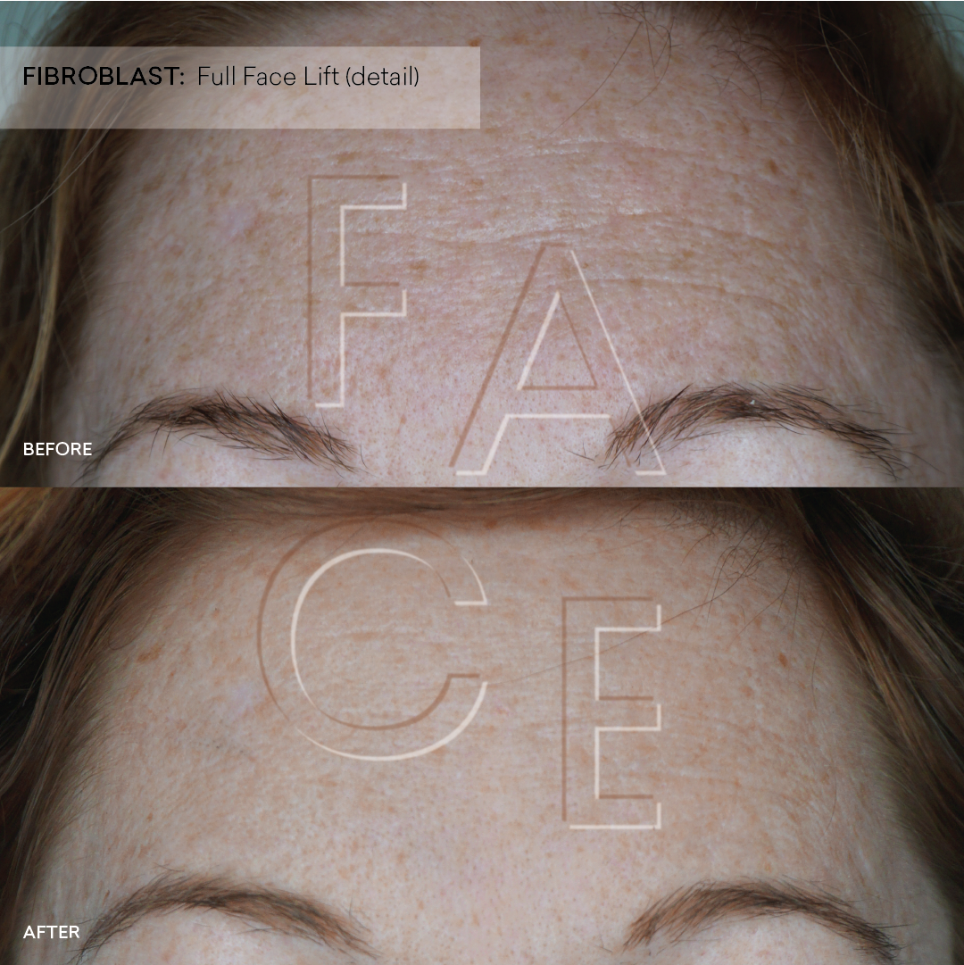 Plasma Fibroblast Skin Tightening with Plasma Pen | Oakland & LA — FACE