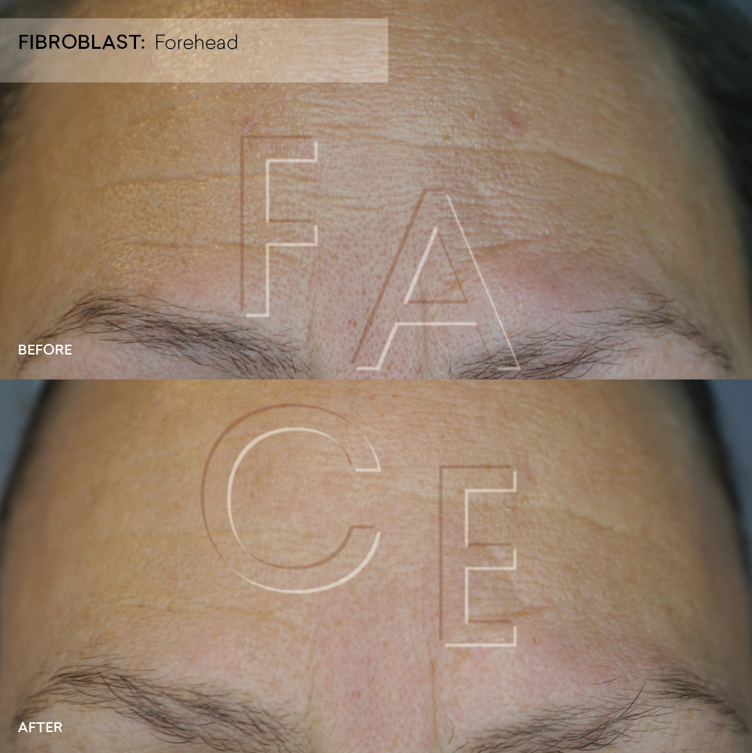 Plasma Fibroblast Skin Tightening with Plasma Pen | Oakland & LA — FACE
