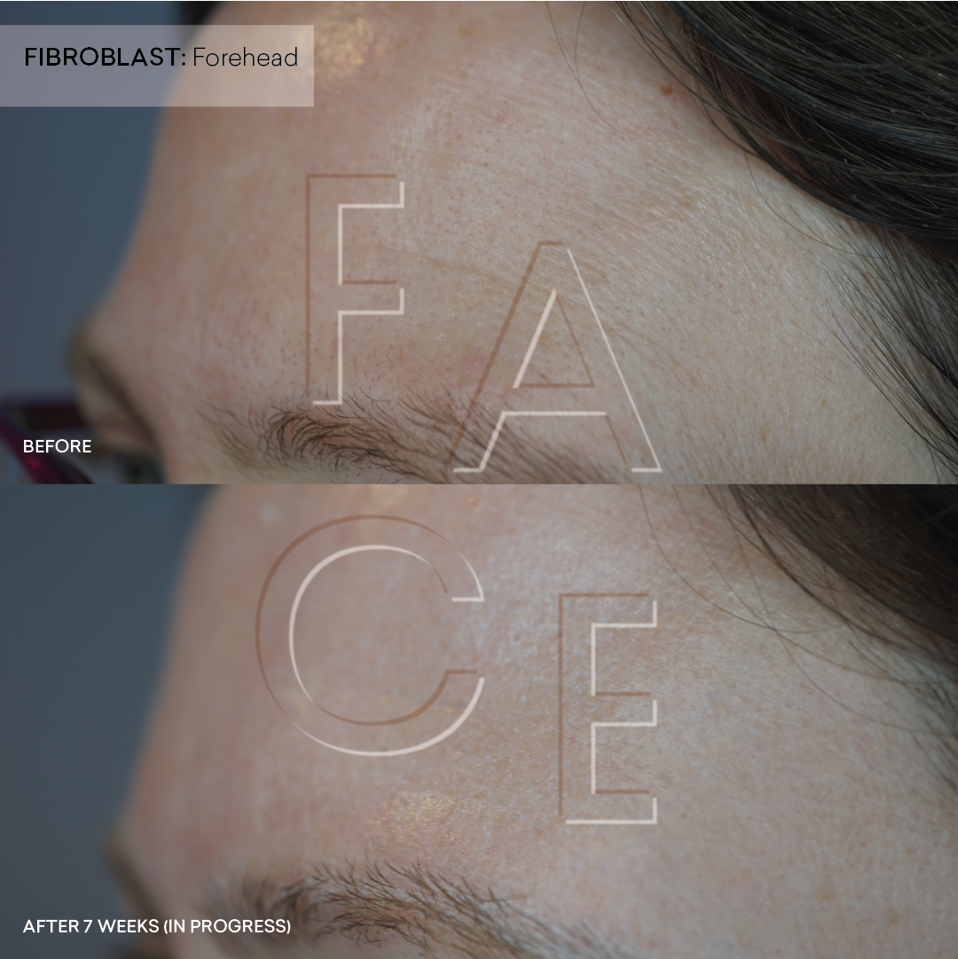 Plasma Fibroblast Skin Tightening with Plasma Pen | Oakland & LA — FACE