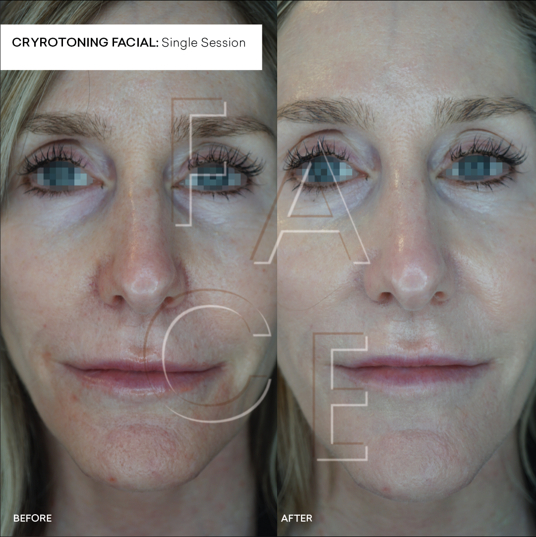 CryoFacial Before And After Results FACE CryoFacial Before And After Results FACE