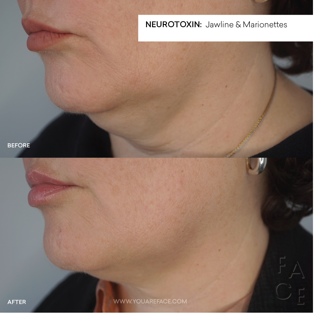 Neurotoxin Injections — FACE