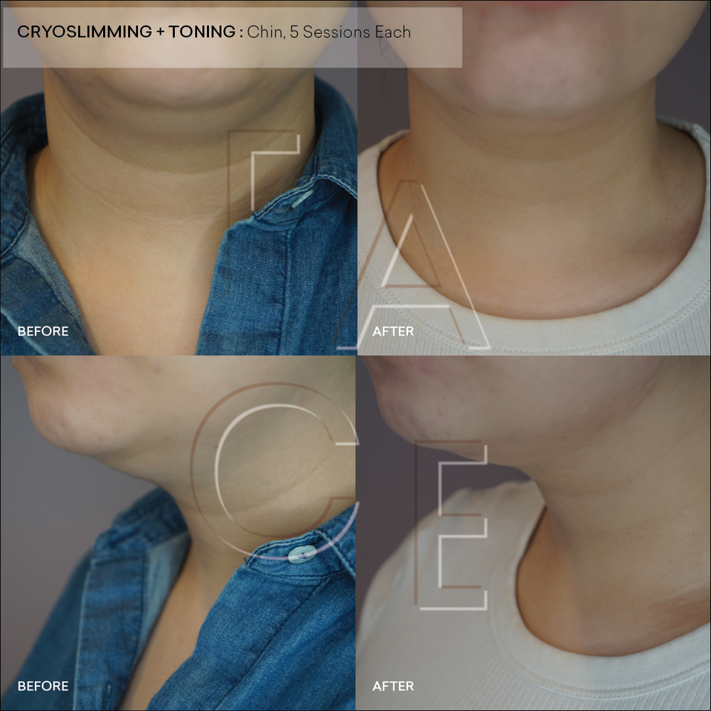 Cryoskin Double Chin: Get a Dreamy Jawline with Cryotherapy — FACE