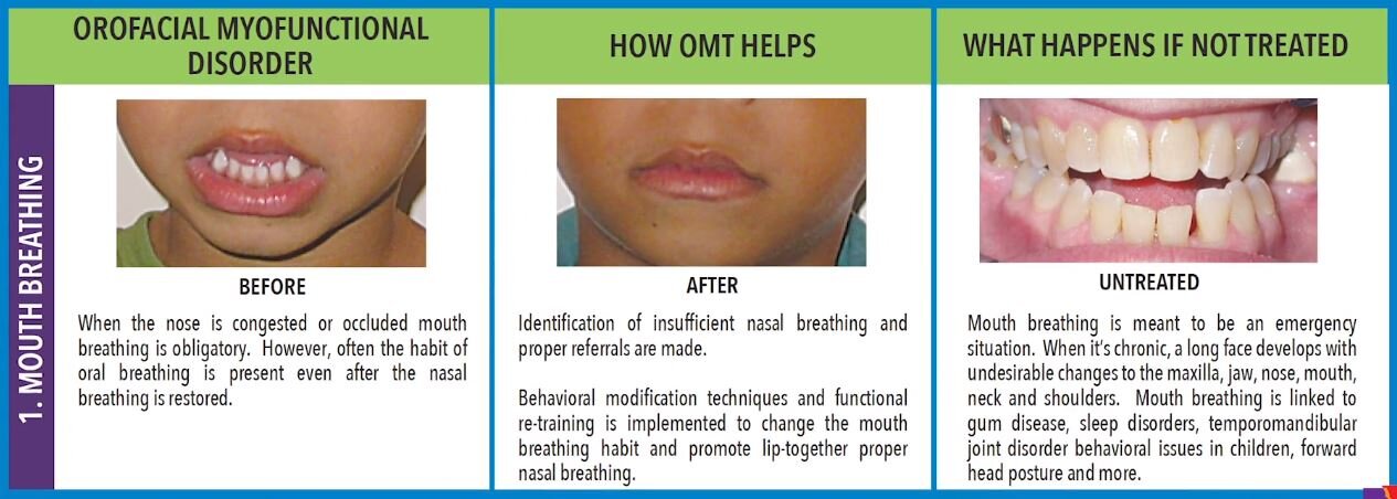 Orofacial Myofunctional Disorders — Mindful Myo, Functional Orofacial ...